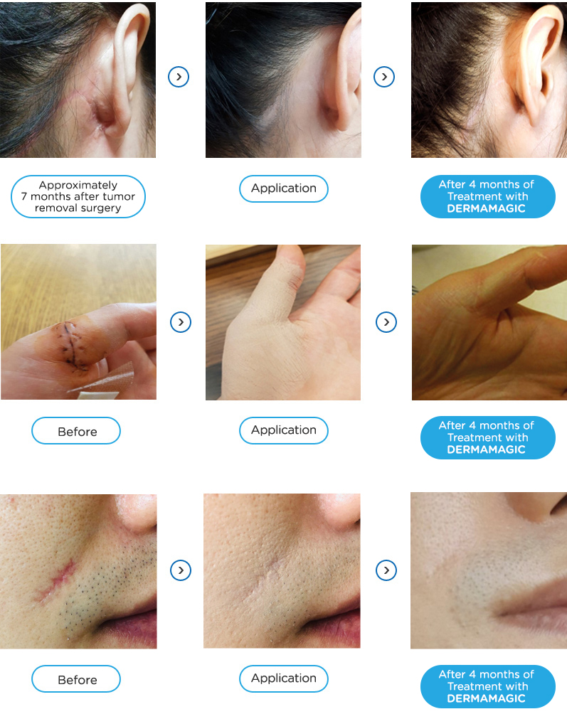 Before and After Photos – 더마매직 – 인터내셔널 홈페이지 | DERMAMAGIC International ...